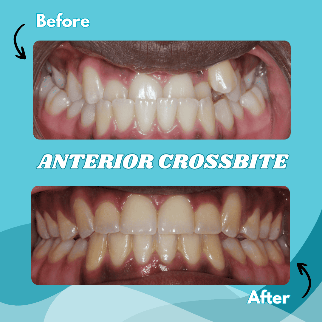 Braces Before and After: How Orthodontic Treatment Fixes Crossbites ...