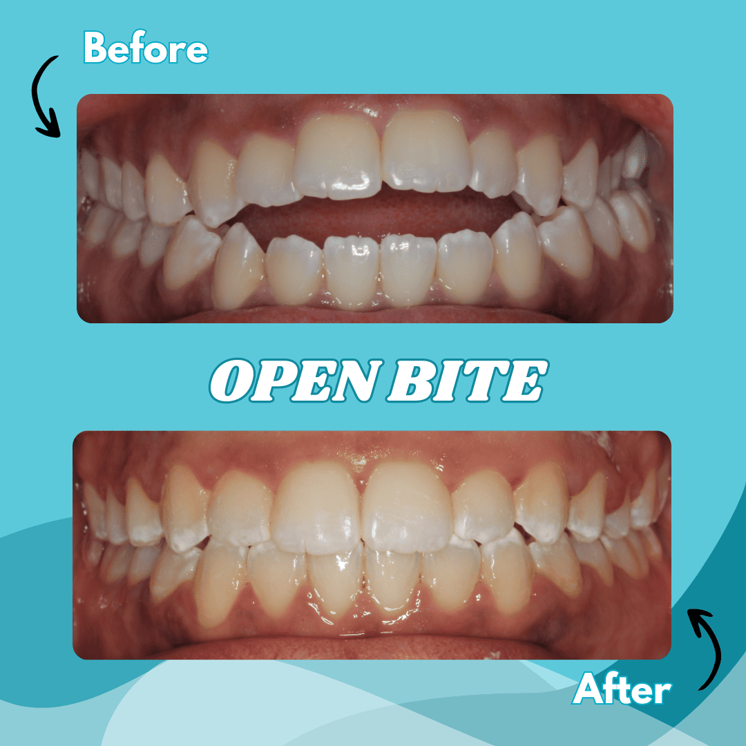 Braces Before and After: How Orthodontic Treatment Fixes Crossbites ...